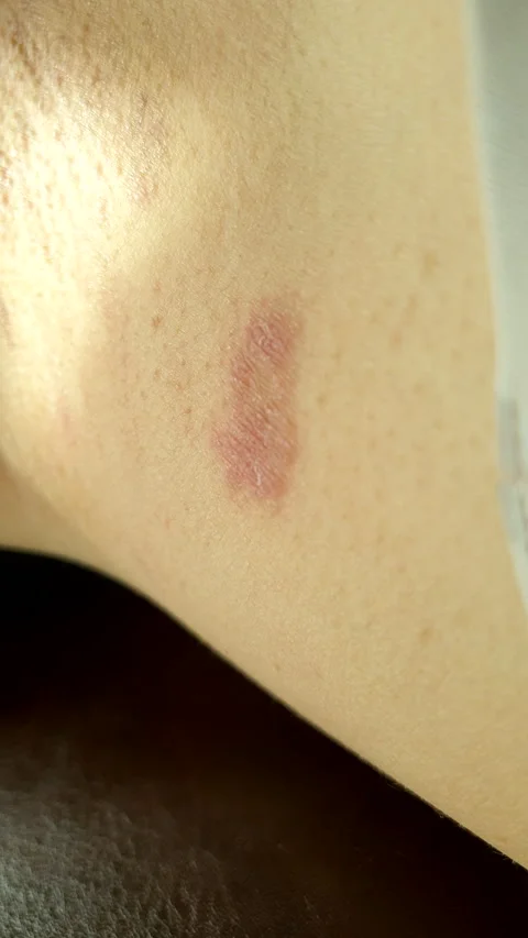 ringworm eczema infected on human body r... | Stock Video | Pond5