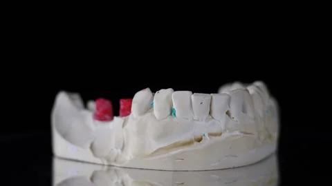 Rotating jaw model with missing teeth in... | Stock Video | Pond5