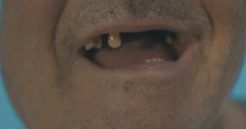 Rotten Teeth Stock Footage ~ Royalty Free Stock Videos | Pond5