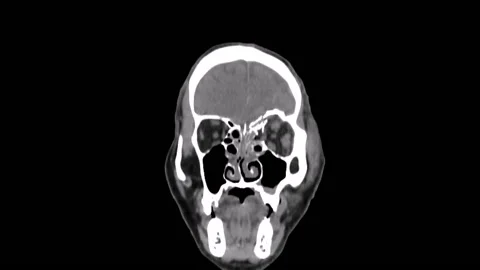 Ruptured eye, CT scan | Stock Video | Pond5