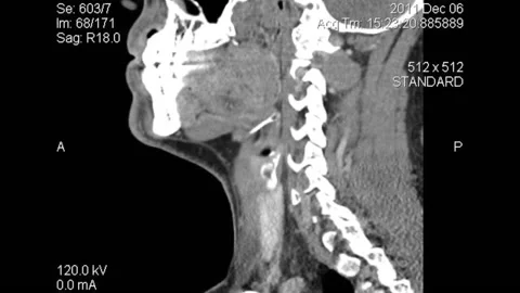 Sagittal plane tomography: CT scan layer... | Stock Video | Pond5