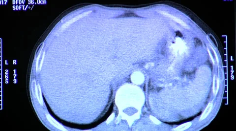 Scan of human body, image on screen, CT ... | Stock Video | Pond5