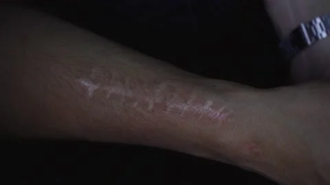 Scar On Arm Stock Video Footage | Royalty Free Scar On Arm Videos | Pond5