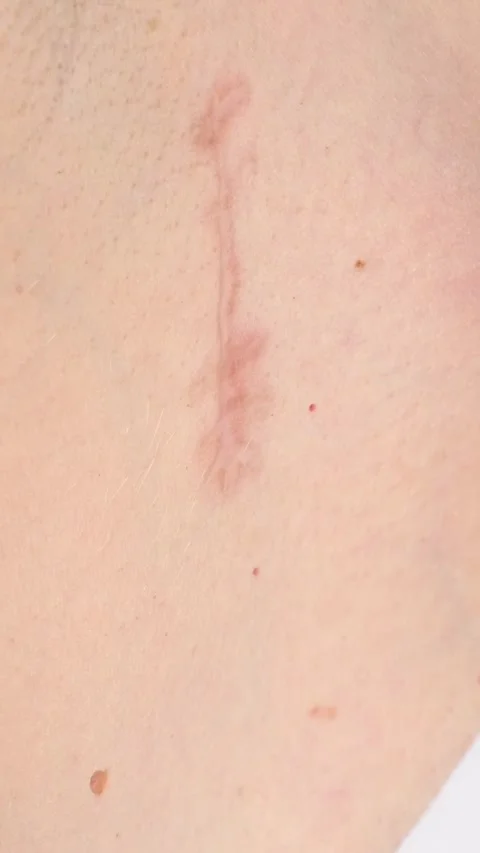 Armpit Surgery Stock Videos – Royalty-Free HD & 4K Videos | Pond5