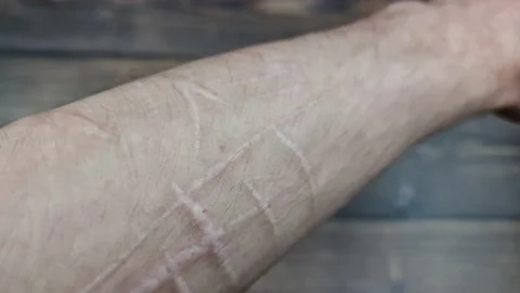 The Scars on the arm. Cut marks on the a... | Stock Video | Pond5