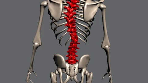 scoliosis, curvature of the spine, hump,... | Stock Video | Pond5