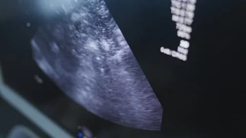 Screen of Modern Ultrasound Machine at H... | Stock Video | Pond5