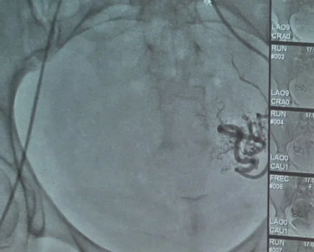 Screen Showing Cardiac Angiogram | Stock Video | Pond5