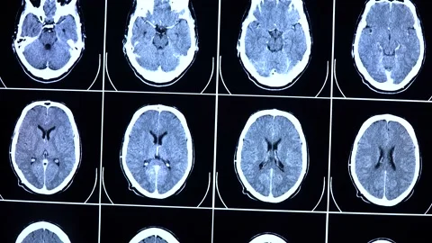 Scrolling CT, MRI brain scan images on a... | Stock Video | Pond5