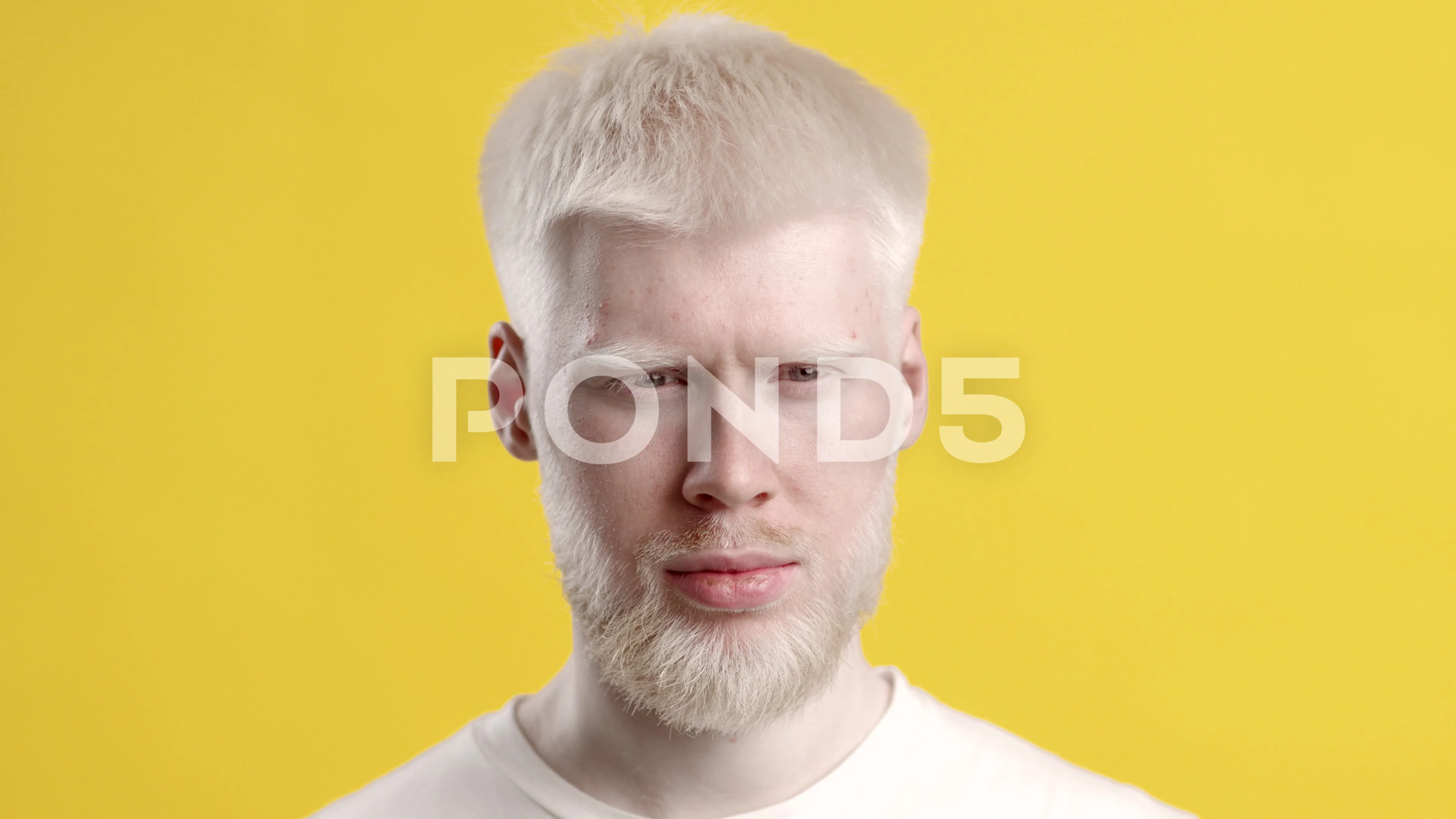 White Albino Man