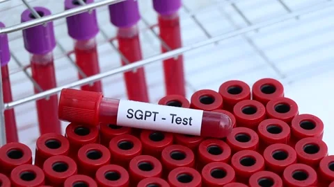 SGPT test to look for abnormalities from... | Stock Video | Pond5