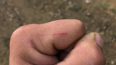 Arm Wound Stock Videos – Royalty-Free HD & 4K Videos | Pond5