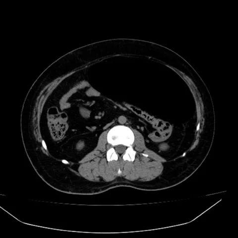 Sigmoid Colon Volvulus CT Scan Examinat... | Stock Video | Pond5