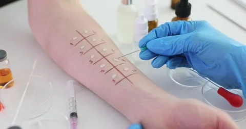 Skin allergy testing procedure in the cl... | Stock Video | Pond5