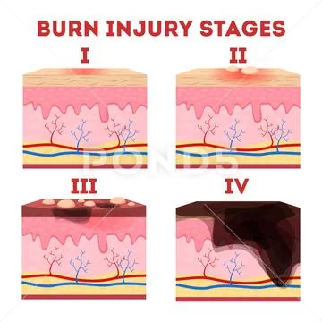 Skin burn injury stages. Anatomy of the skin.: Royalty Free #109094406
