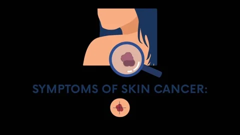 Skin cancer symptoms 2D animation on tra... | Stock Video | Pond5