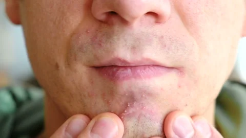 Skin irritation after shaving. Man's han... | Stock Video | Pond5