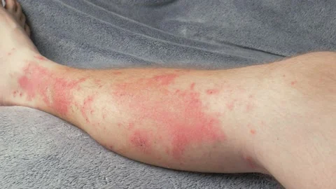 Skin rash on lower leg | Stock Video | Pond5