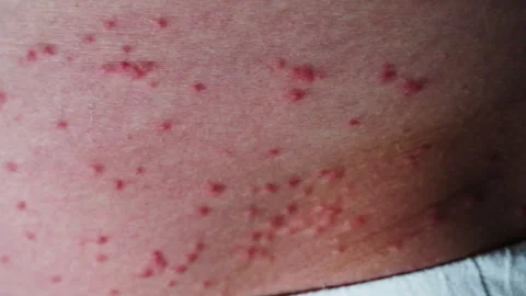 Skin rash - Pimples on the skin, Summert... | Stock Video | Pond5