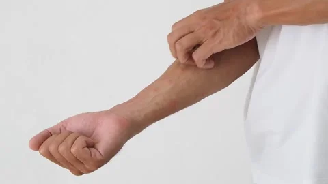 Skin rash, rashes caused by allergic rea... | Stock Video | Pond5