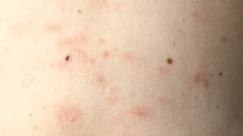 skin rash treatment on woman body. Shing... | Stock Video | Pond5