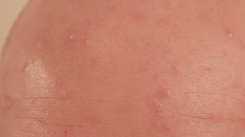 Skin rashes from chicken pox on a man's ... | Stock Video | Pond5