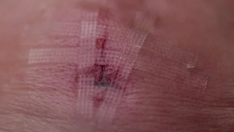 Slash skin injury blood and hematoma. | Stock Video | Pond5