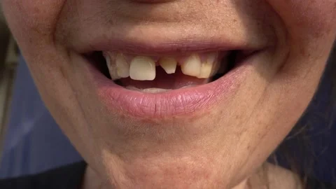 Smiling woman mouth with one tooth crown... | Stock Video | Pond5