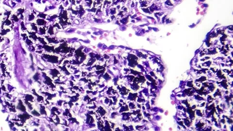 Smoker's lung tissue, light microscopy | Stock Video | Pond5