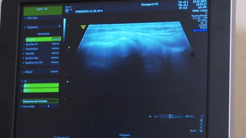 Sonography. The screen of the ultrasound... | Stock Video | Pond5