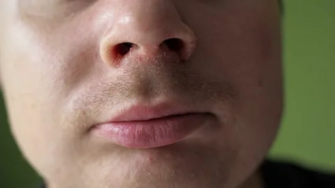 a sore nose after a runny nose close-up.... | Stock Video | Pond5