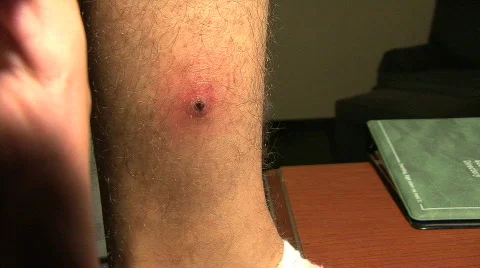 Spider Bite 01 | Stock Video | Pond5