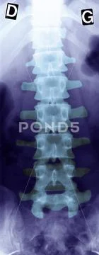 Spinal column, x-ray X-ray of the healthy spinal column of a 29-year ...