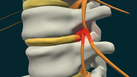 Spinal disc herniation, 3d educational a... | Stock Video | Pond5