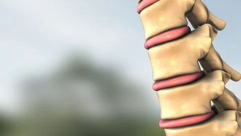 Spinal Wedge Compression Fracture Causin... | Stock Video | Pond5