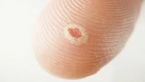 Splinter wound on the finger. A hole in ... | Stock Video | Pond5