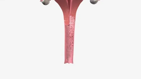 Stage 3 cervical cancer means the cancer... | Stock Video | Pond5