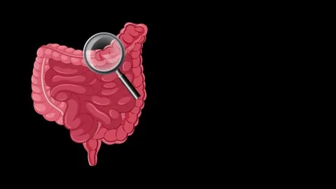 Step-by-Step Endoscopic Polyp Removal in... | Stock Video | Pond5