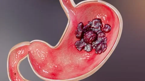 Stomach cancer. stages tumor growth in d... | Stock Video | Pond5