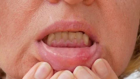 stomatitis in mouth closeup, lip with ap... | Stock Video | Pond5