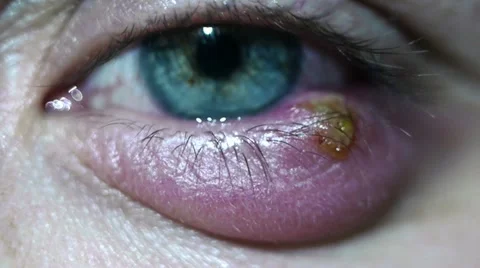 Stye eye Infection | Stock Video | Pond5
