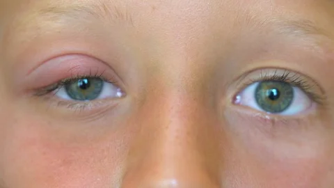 Stye Eye Stock Videos – Royalty-Free HD & 4K Videos