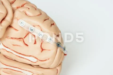 Subdural grid electrode for brain waves recording on the base of brain ~ Premium Photo #109413649