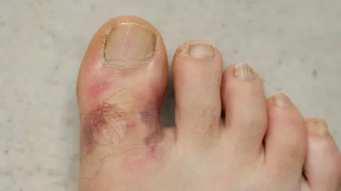 Swollen and bruised toe, after injury | Stock Video | Pond5