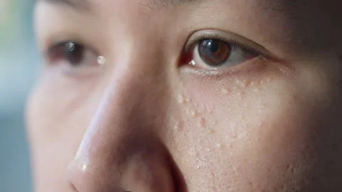 Syringoma or milia milium cysts or sebor... | Stock Video | Pond5