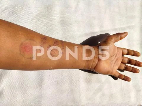 TB skin test is also called the Mantoux tuberculin skin test ,TST ...