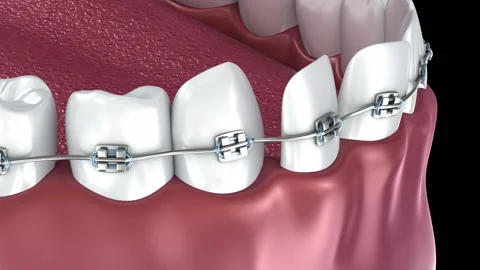 Teeth with braces Alignment process. 3D ... | Stock Video | Pond5
