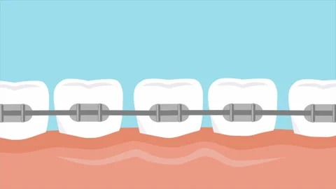 Teeth with braces alignment process. Med... | Stock Video | Pond5
