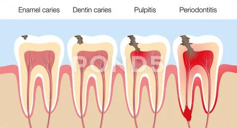 Teeth Caries Stages Pulpitis Periodontitis Enamel Caries: Graphic ...