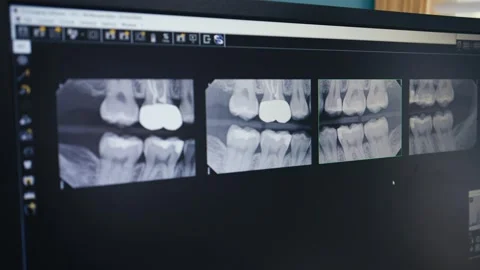 teeth dental x rays on a computer screen... | Stock Video | Pond5